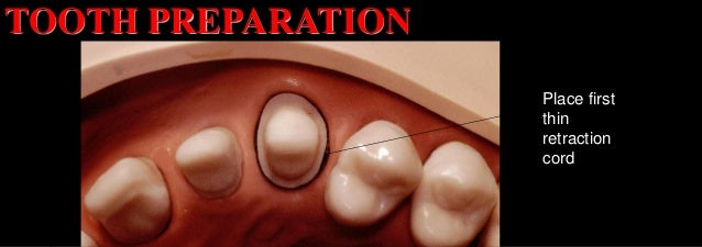 Zirconia Crown Prep