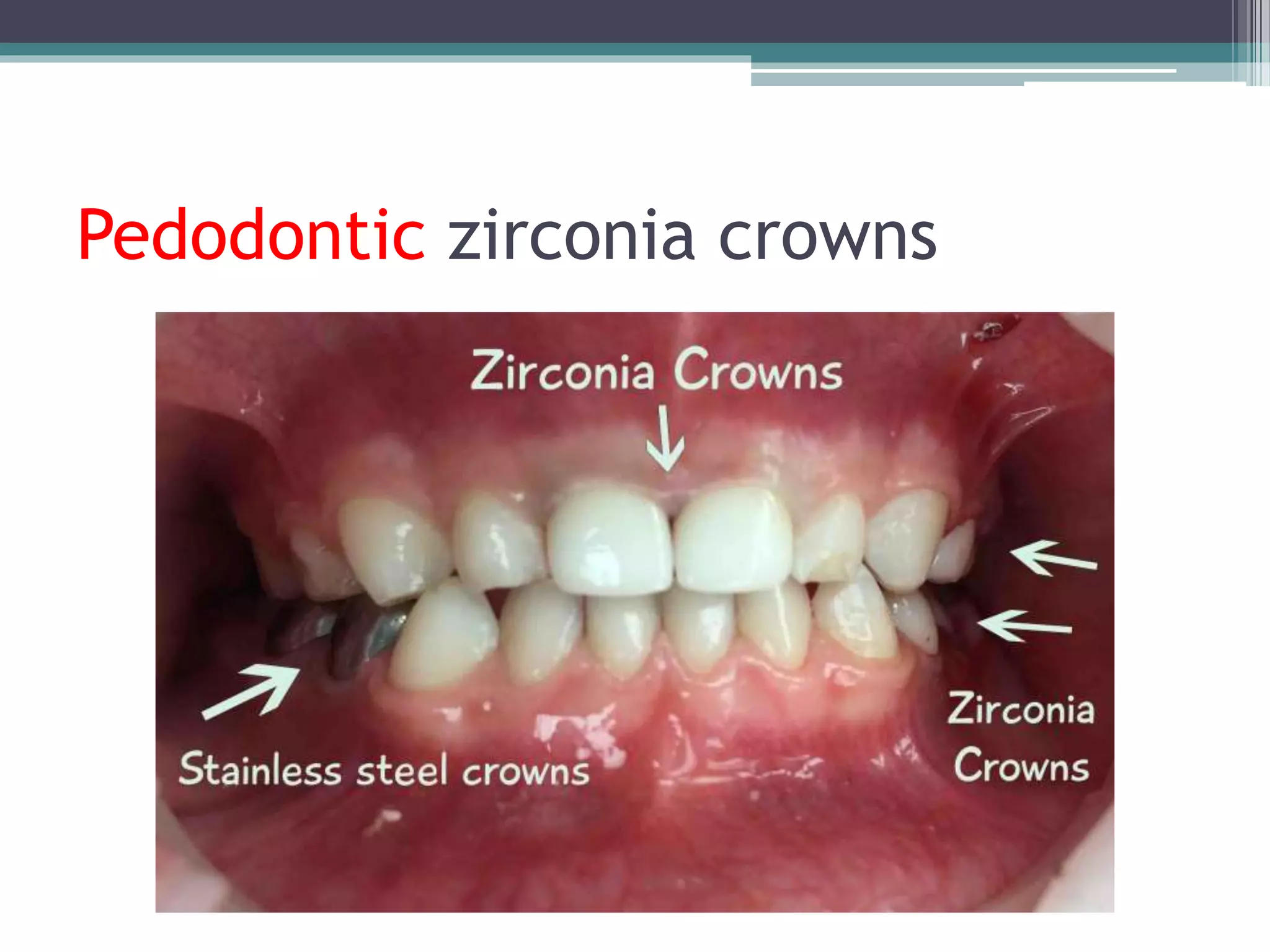Zirconia overview | PPTX