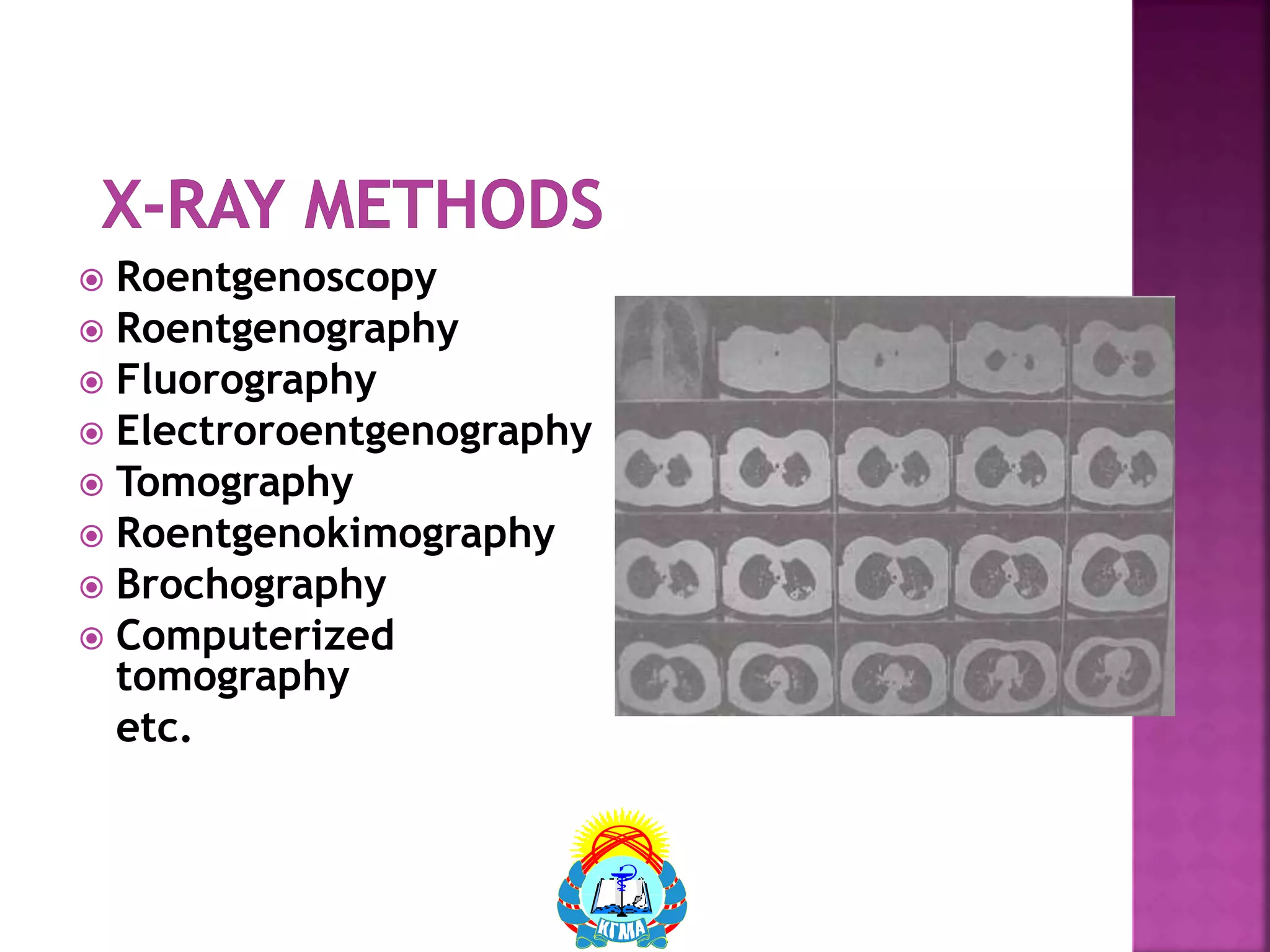 tuberculosis - CAVERNOUS TUBERCULOSIS | PPTX