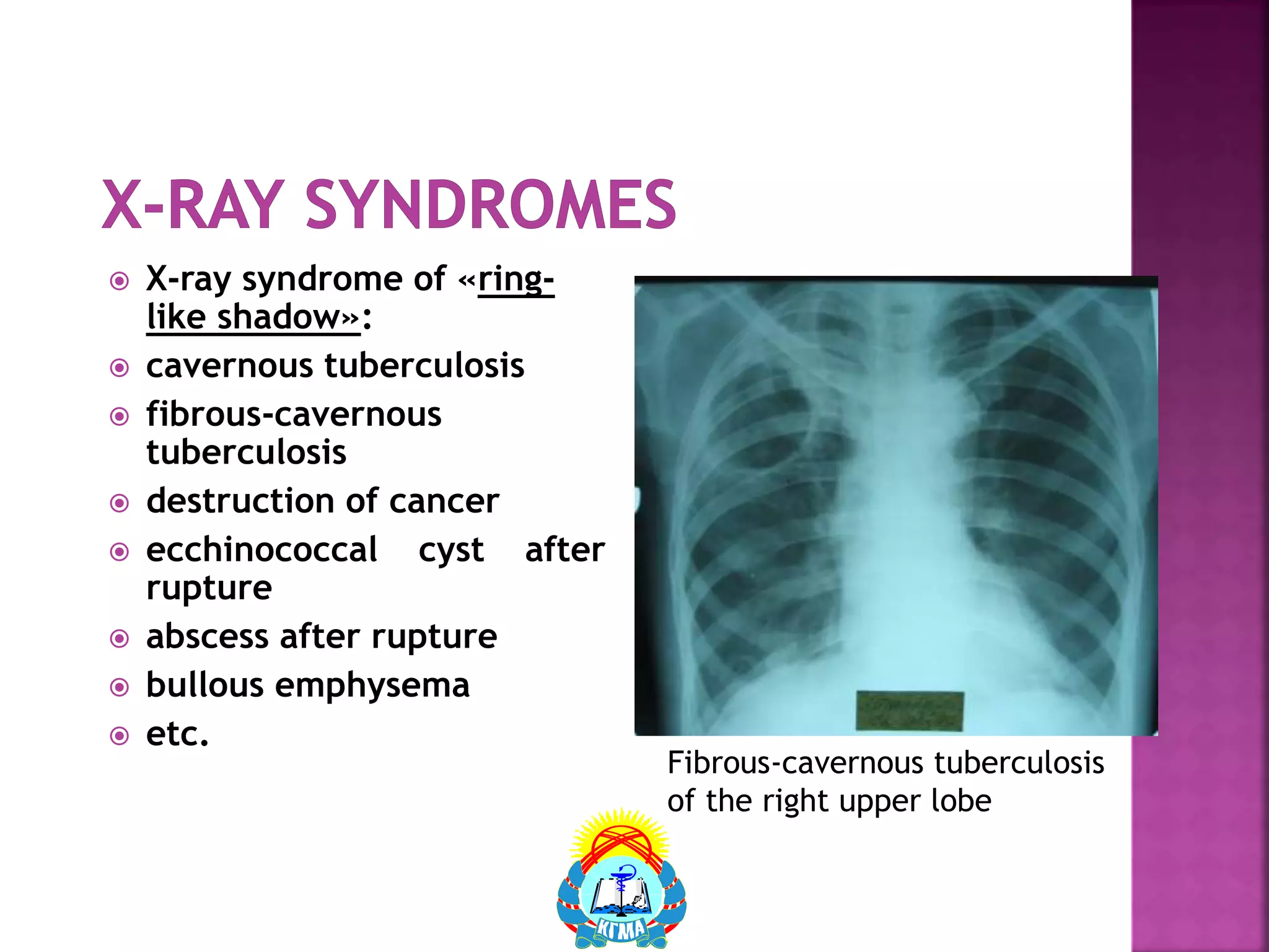 tuberculosis - CAVERNOUS TUBERCULOSIS | PPTX