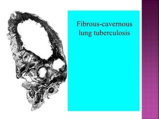 tuberculosis - CAVERNOUS TUBERCULOSIS | PPTX