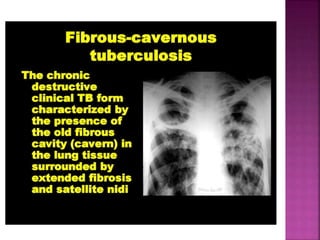 tuberculosis - CAVERNOUS TUBERCULOSIS | PPTX