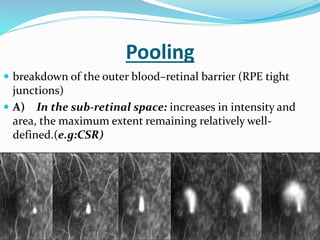 Eye Flourecein Angiography | PPTX