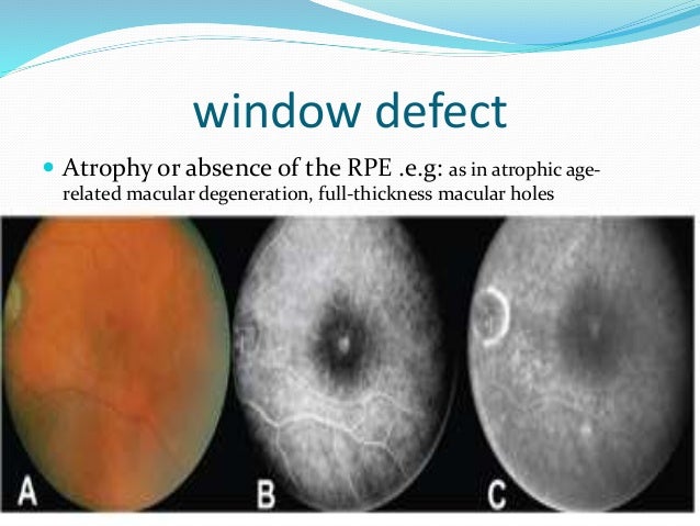 Eye Flourecein Angiography