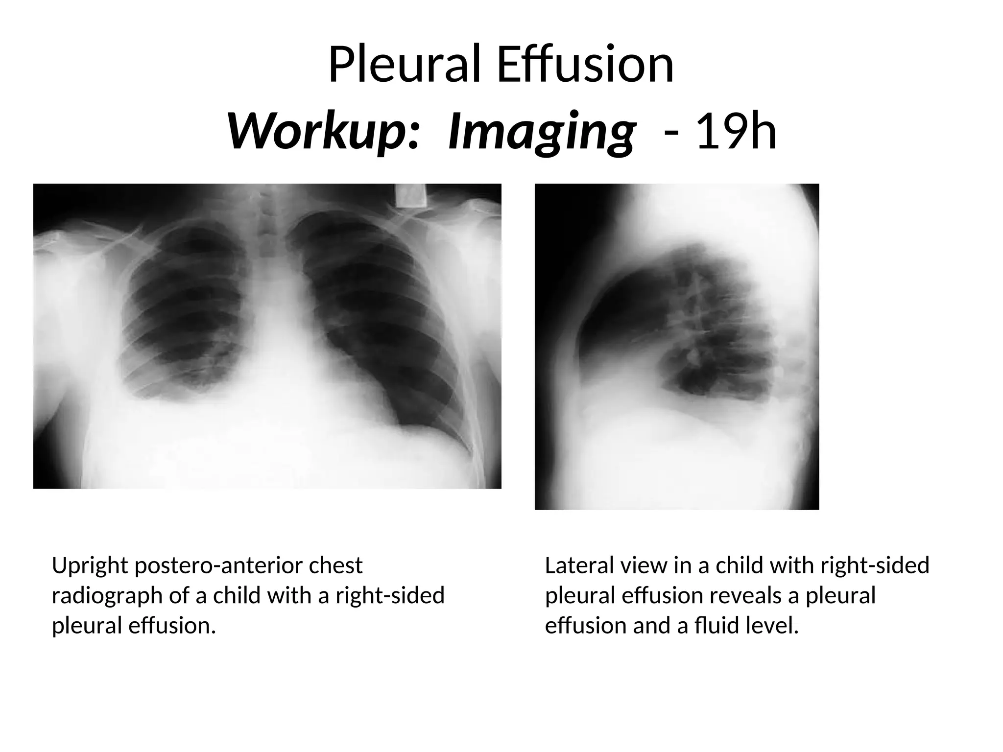 Zm-B411-L5-Pleural Effusion.ppt Zm-B411-L5-Pleural Effusion.ppt