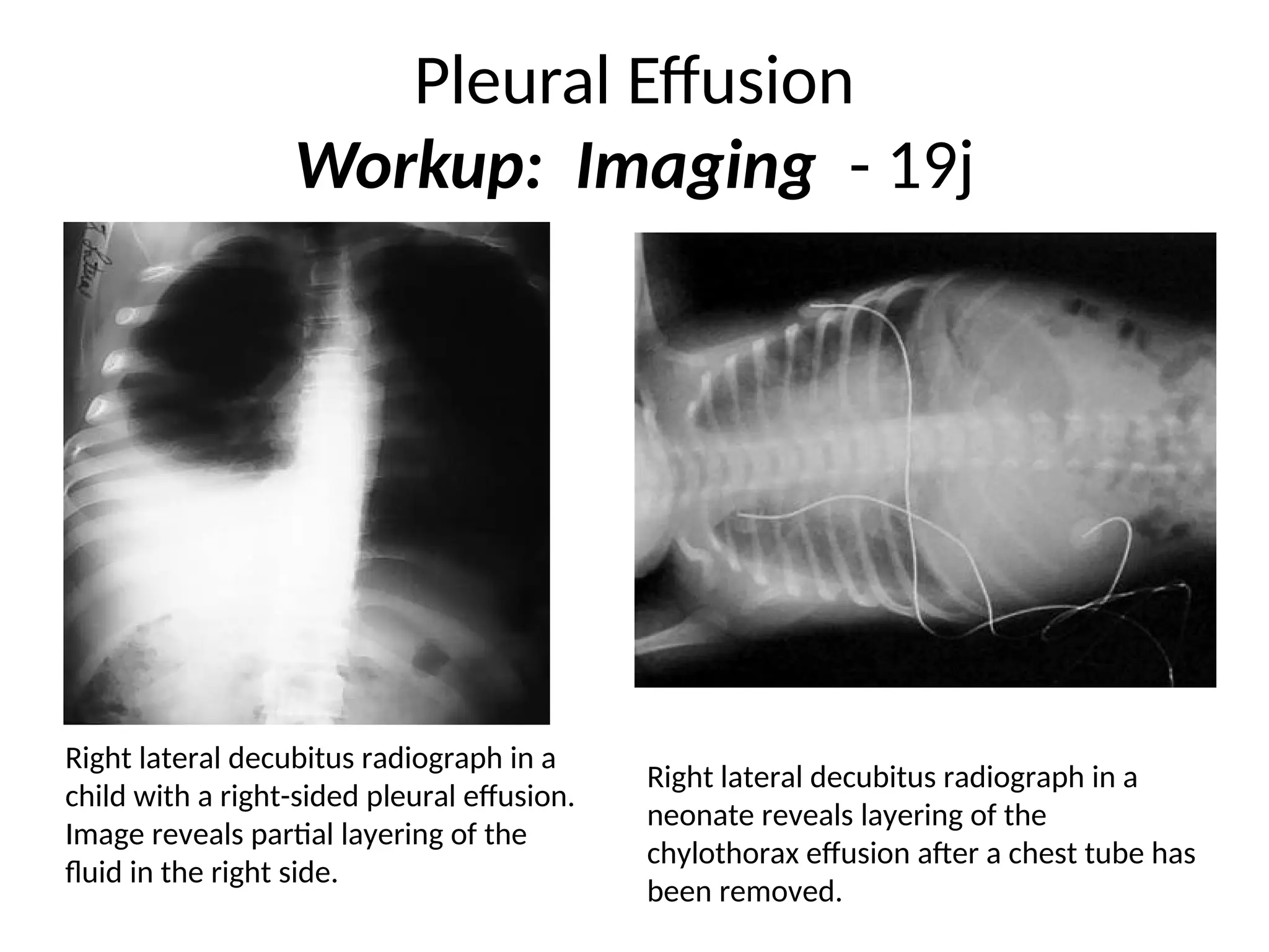 Zm-B411-L5-Pleural Effusion.ppt Zm-B411-L5-Pleural Effusion.ppt