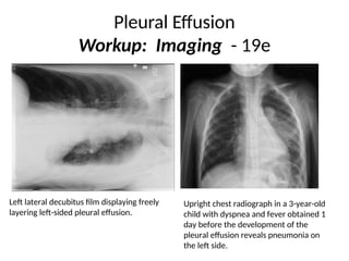 Zm-B411-L5-Pleural Effusion.ppt Zm-B411-L5-Pleural Effusion.ppt