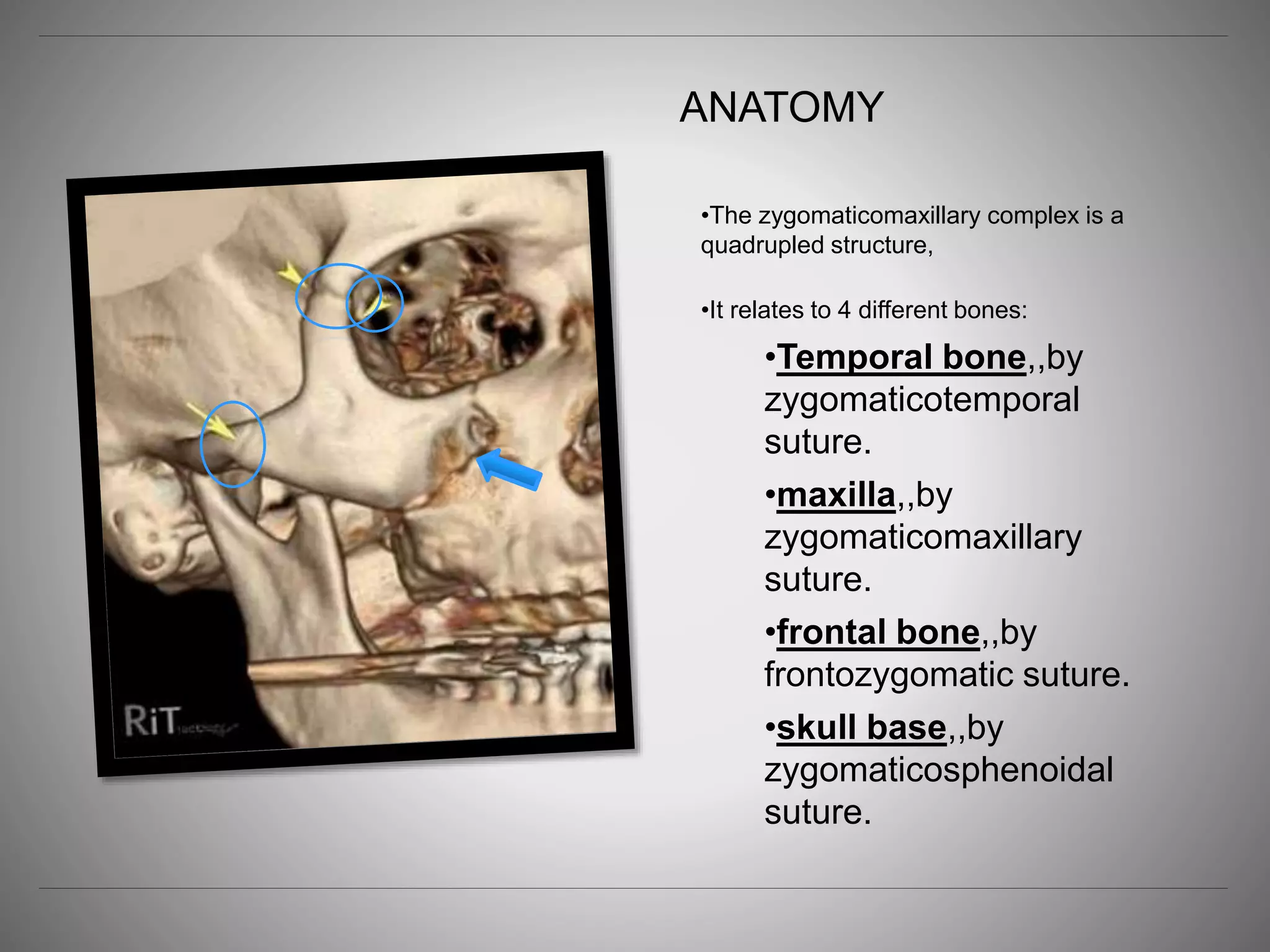 Midfacial fracture | PPTX