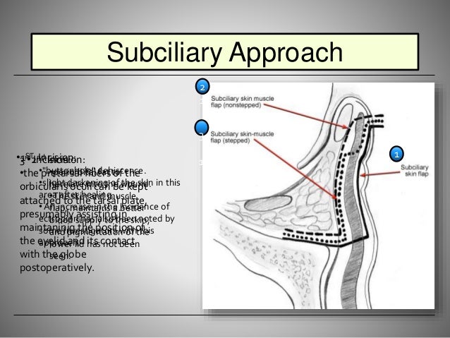 Midfacial fracture