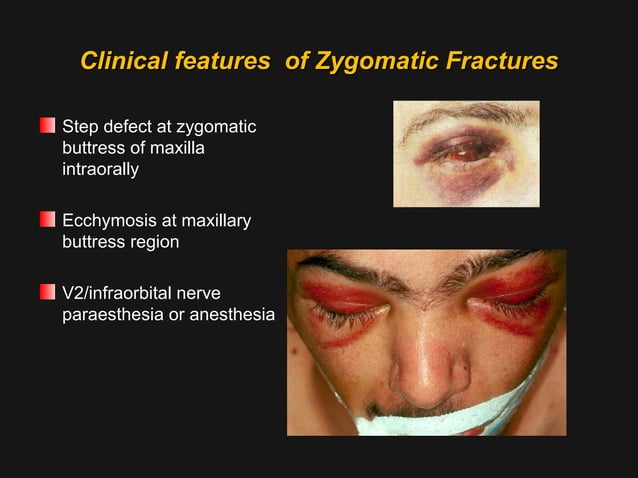 Zmc fracture..by Dr.GPK/ Dr.G.P.Kumar/Dr.G.Padmanabha Kumar | PPT ...