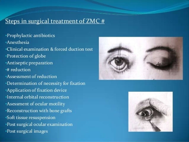 Zmc fracture..by Dr.GPK/ Dr.G.P.Kumar/Dr.G.Padmanabha Kumar | PPT ...