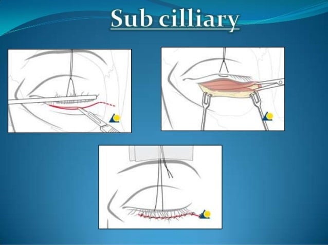 Zmc fracture..by Dr.GPK/ Dr.G.P.Kumar/Dr.G.Padmanabha Kumar | PPT ...