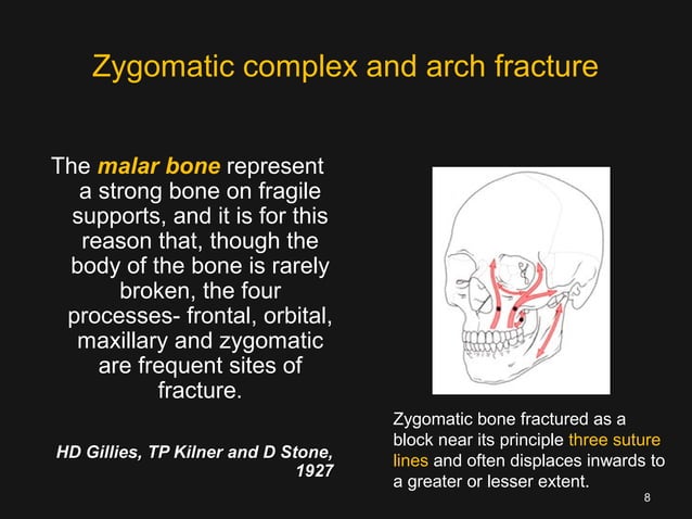 Zmc fracture..by Dr.GPK/ Dr.G.P.Kumar/Dr.G.Padmanabha Kumar | PPT ...