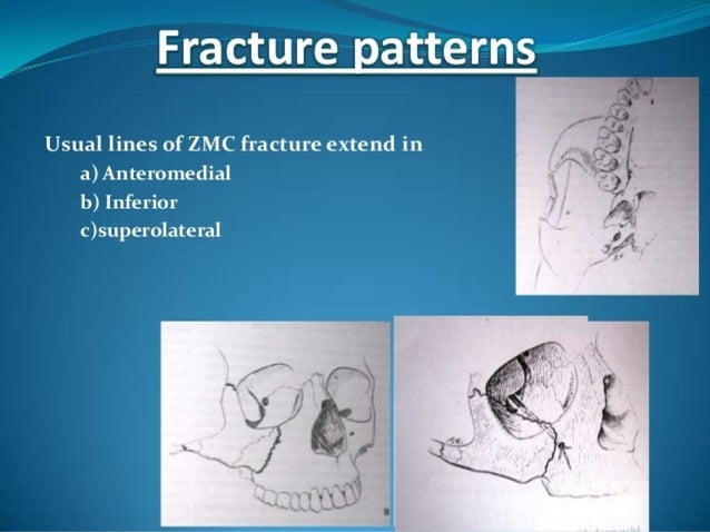 Zmc fracture..by Dr.GPK/ Dr.G.P.Kumar/Dr.G.Padmanabha Kumar