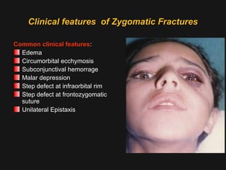 Zmc fracture..by Dr.GPK/ Dr.G.P.Kumar/Dr.G.Padmanabha Kumar | PPT