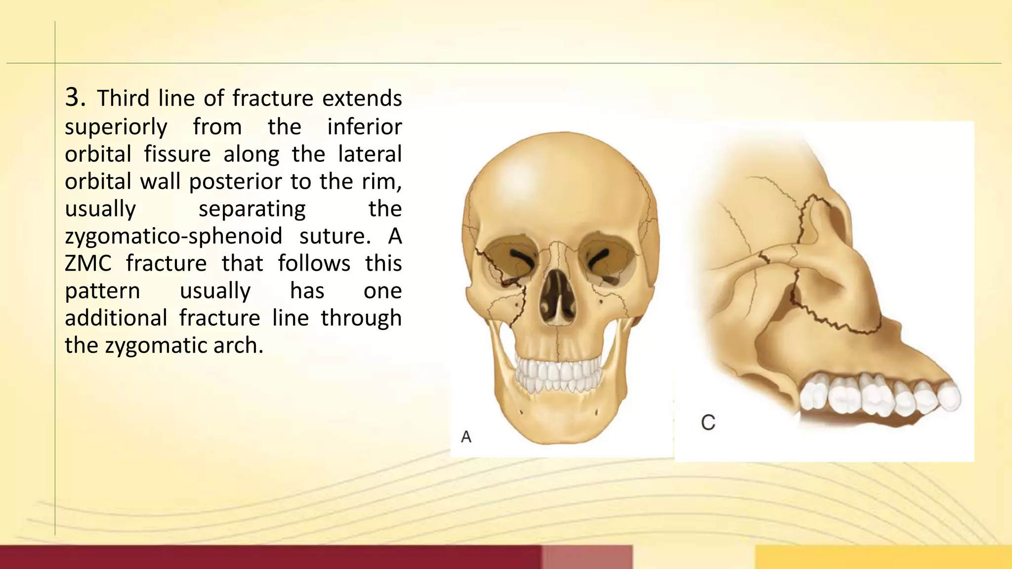 Zmc fracture | PPTX