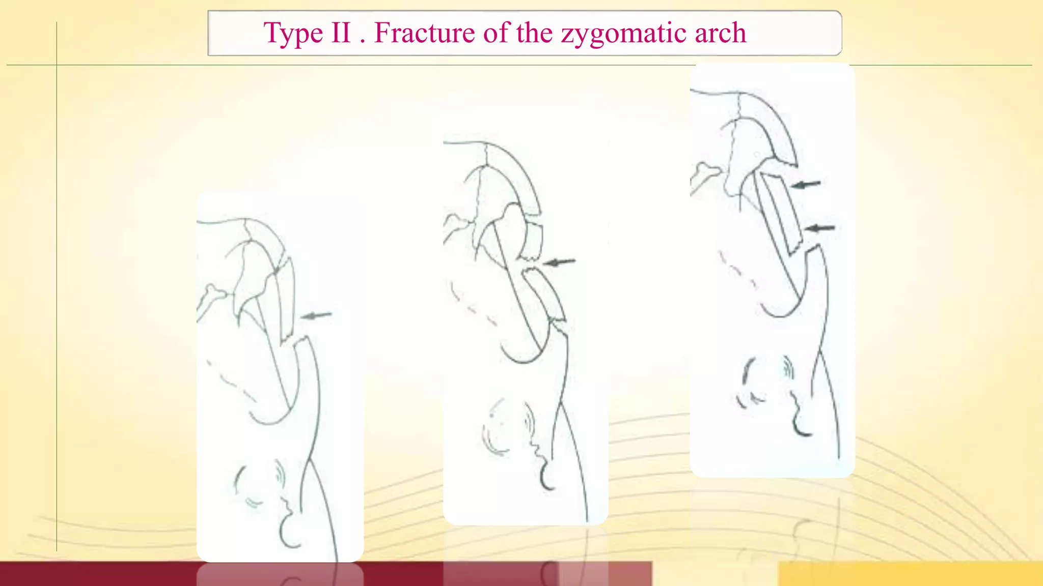 Zmc fracture | PPTX