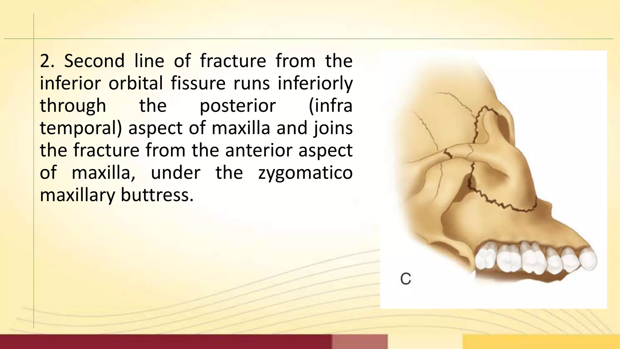 Zmc fracture | PPTX