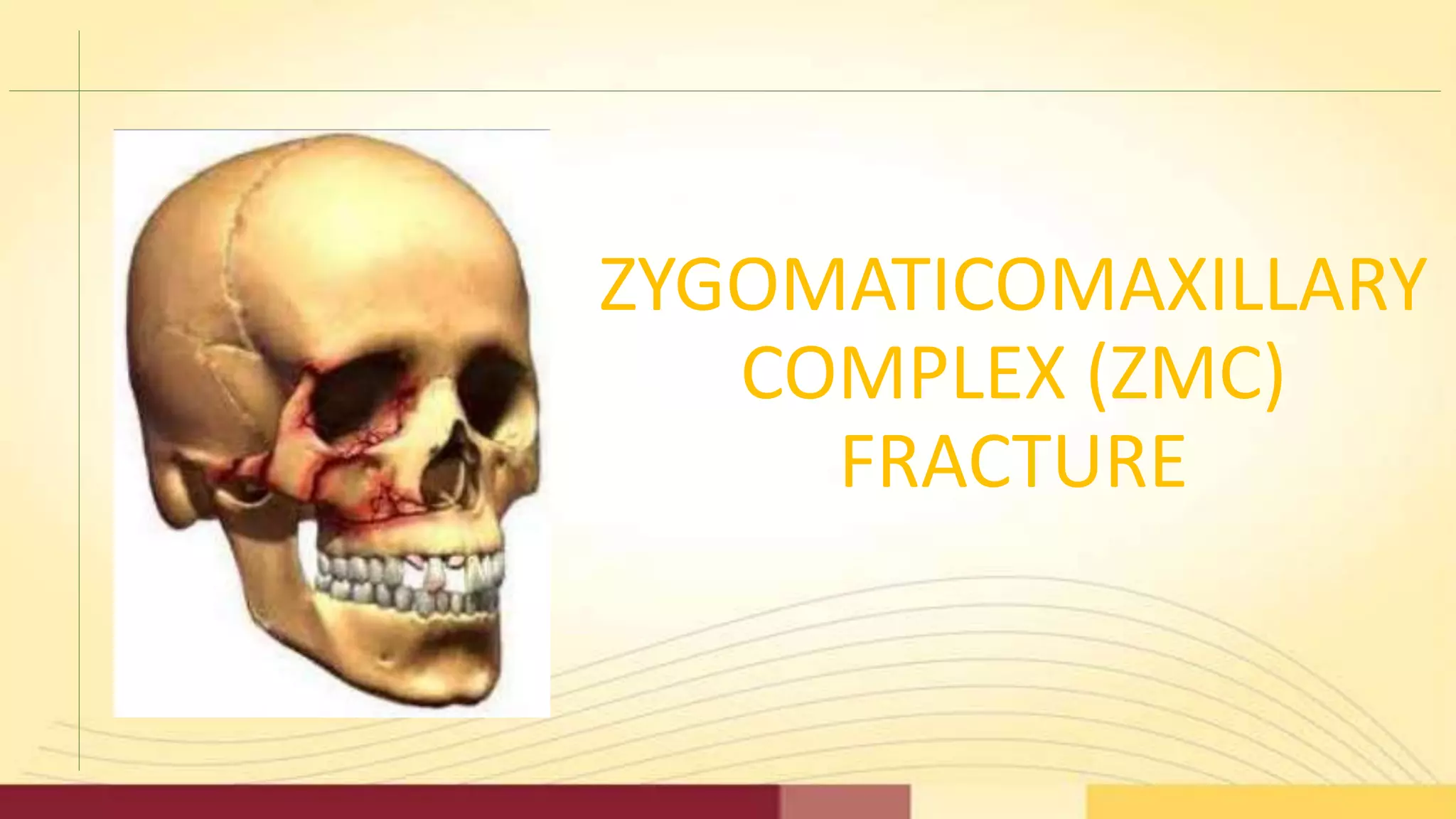 ZMC Fracture Reduction Techniques | PPT