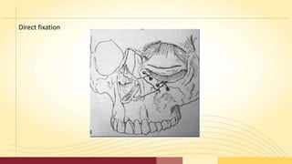 Zmc fracture | PPTX