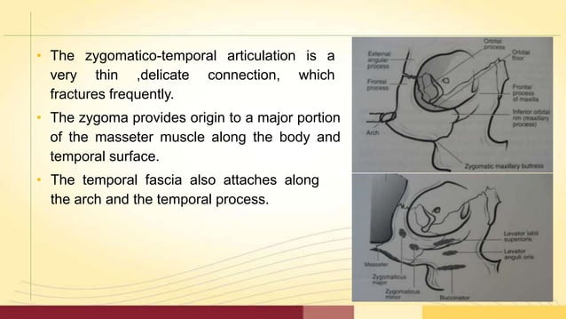 Zmc fracture | PPTX