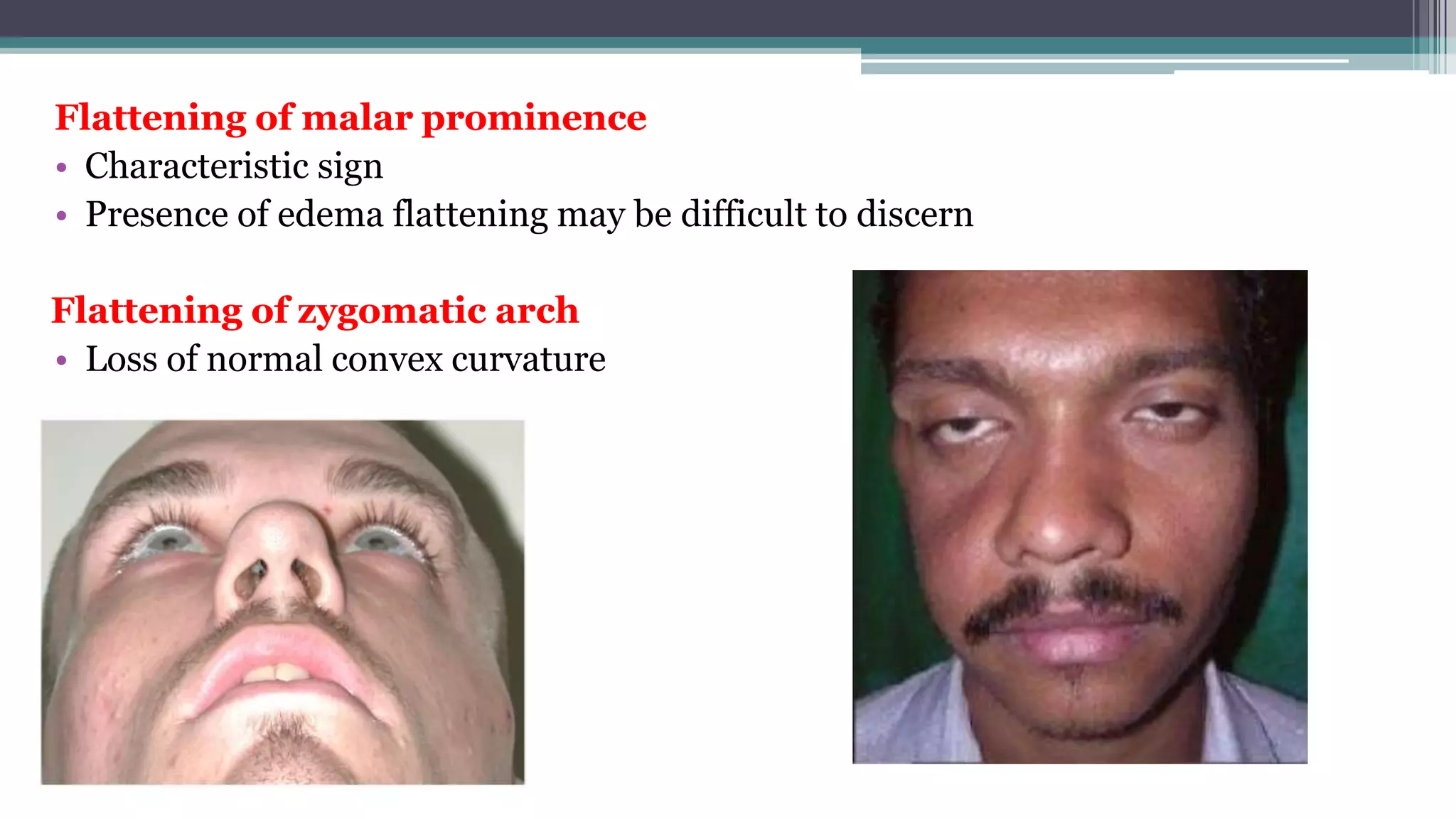 ZMC Fracture.pptx