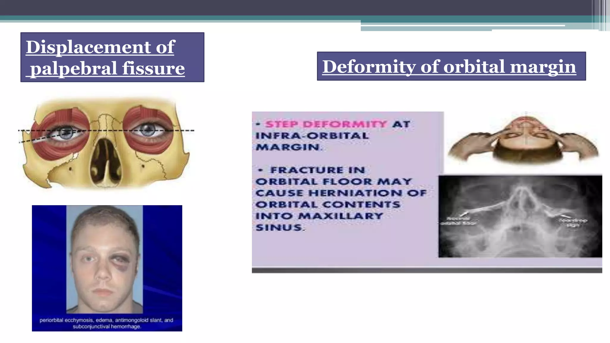 ZMC Fracture.pptx