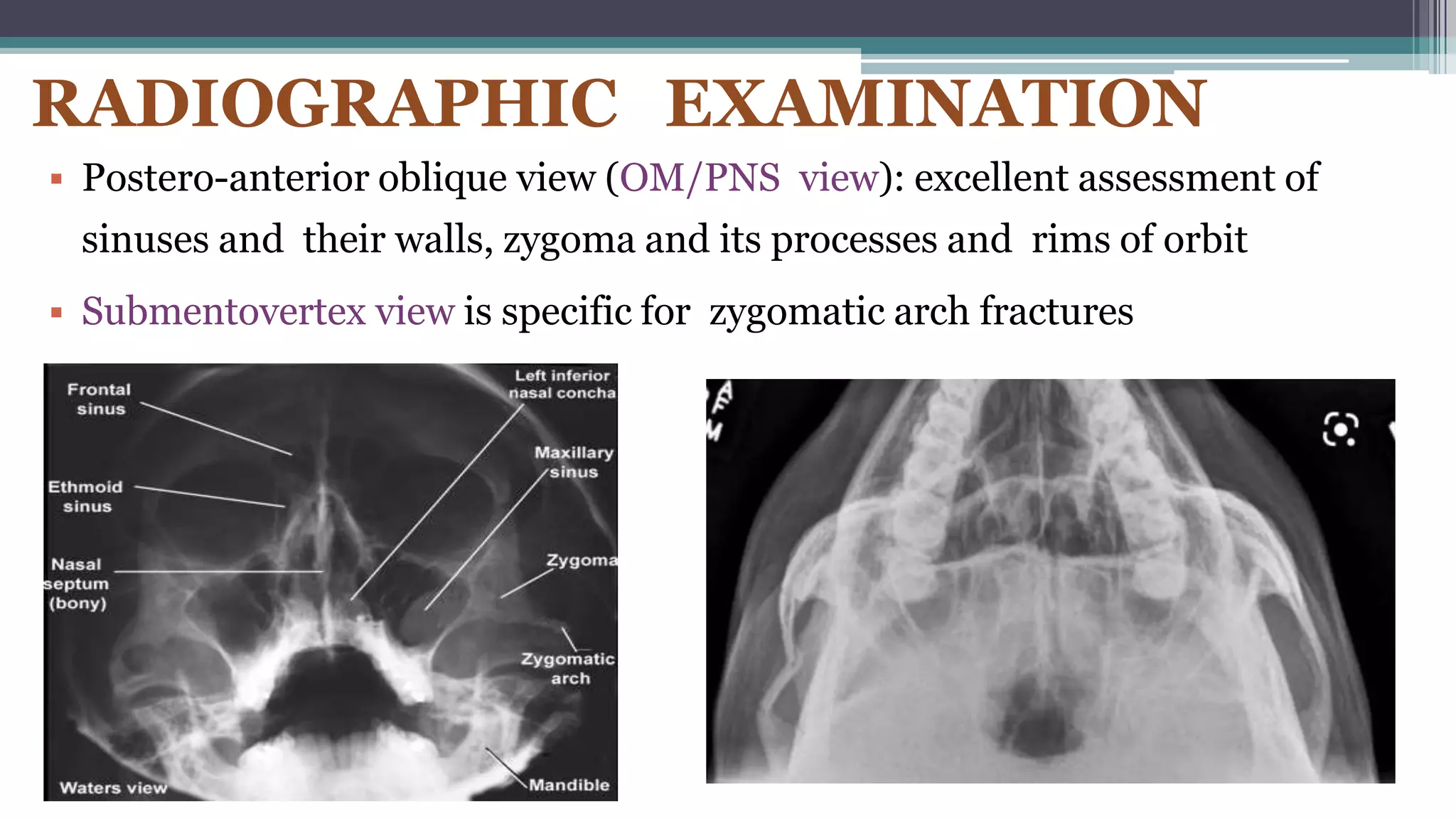 ZMC Fracture.pptx