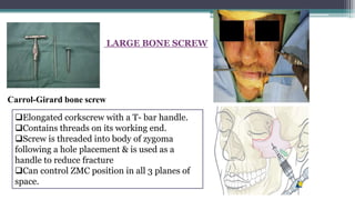 ZMC Fracture.pptx