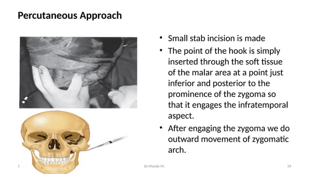 Zygomaticomaxillary complex Fracture pptx | PPT