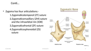 Zygomaticomaxillary complex Fracture pptx | PPTX