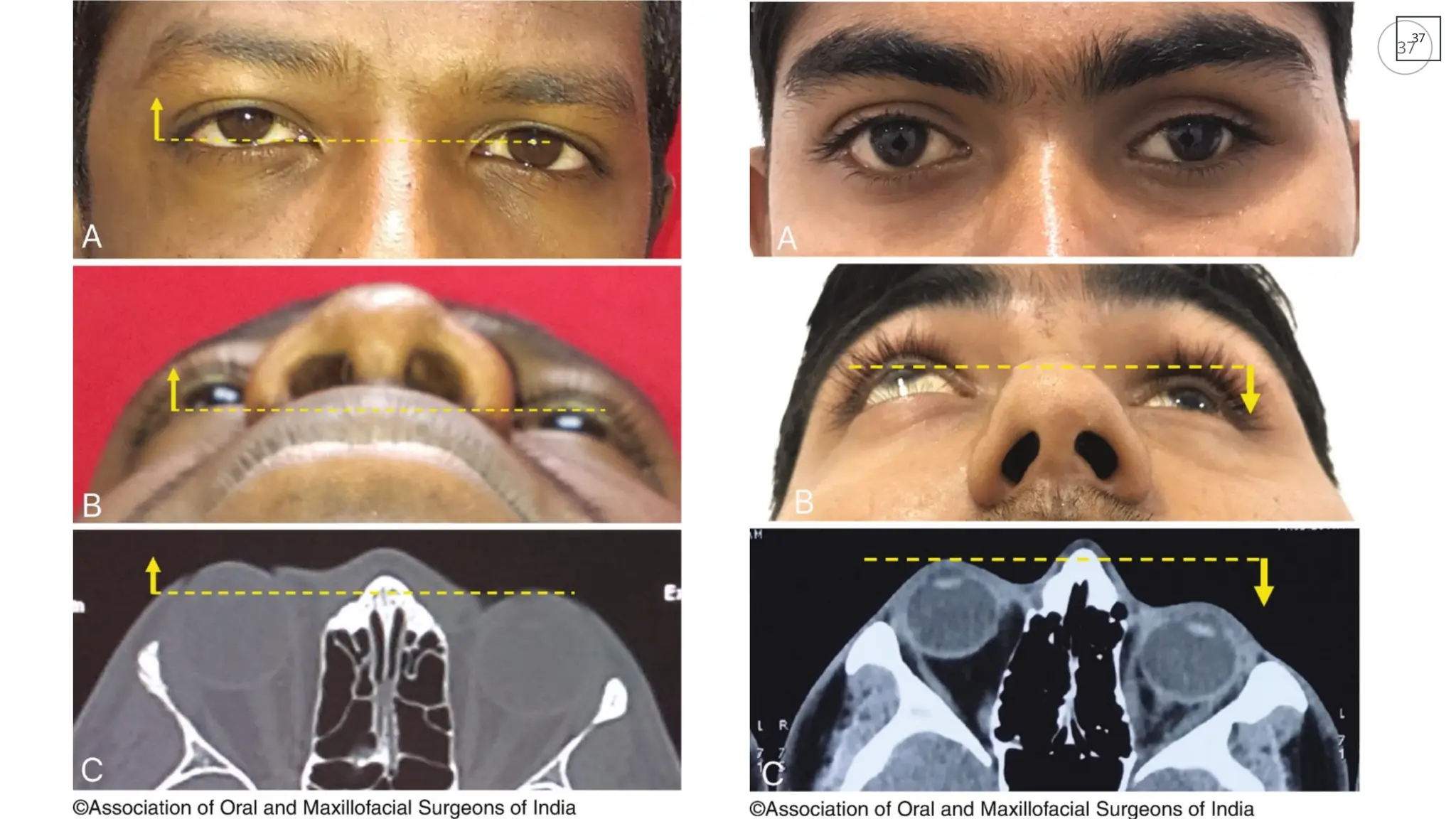ZMC Fractures in oral and maxillofacial surgery.pptx