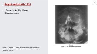 ZMC Fractures in oral and maxillofacial surgery.pptx