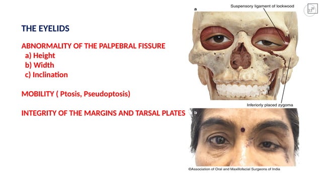 ZMC Fractures in oral and maxillofacial surgery.pptx