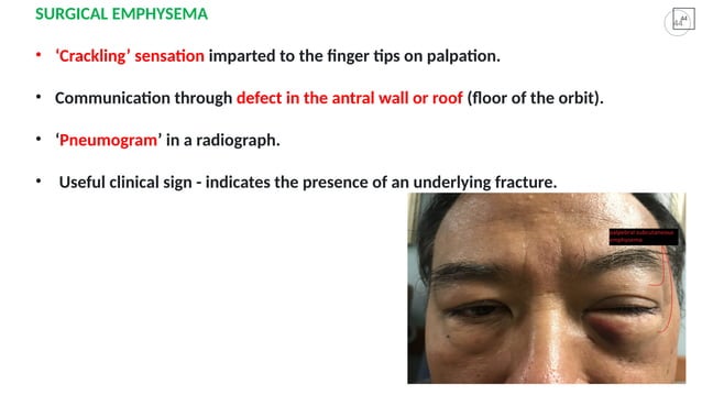 ZMC Fractures in oral and maxillofacial surgery.pptx