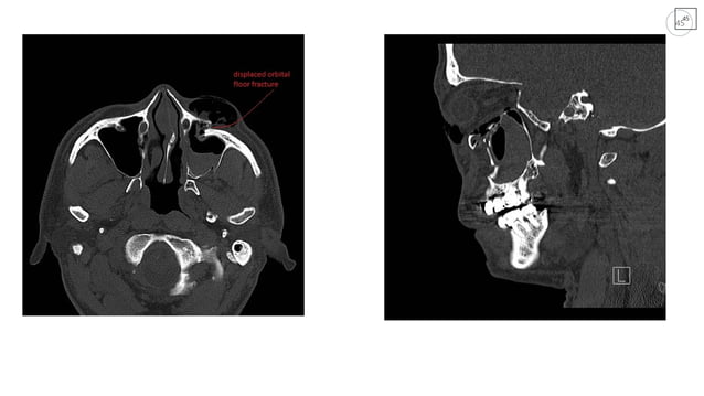 ZMC Fractures in oral and maxillofacial surgery.pptx