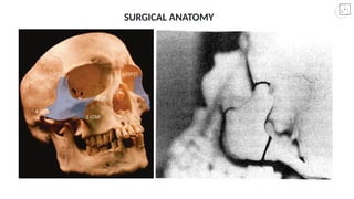 ZMC Fractures in oral and maxillofacial surgery.pptx