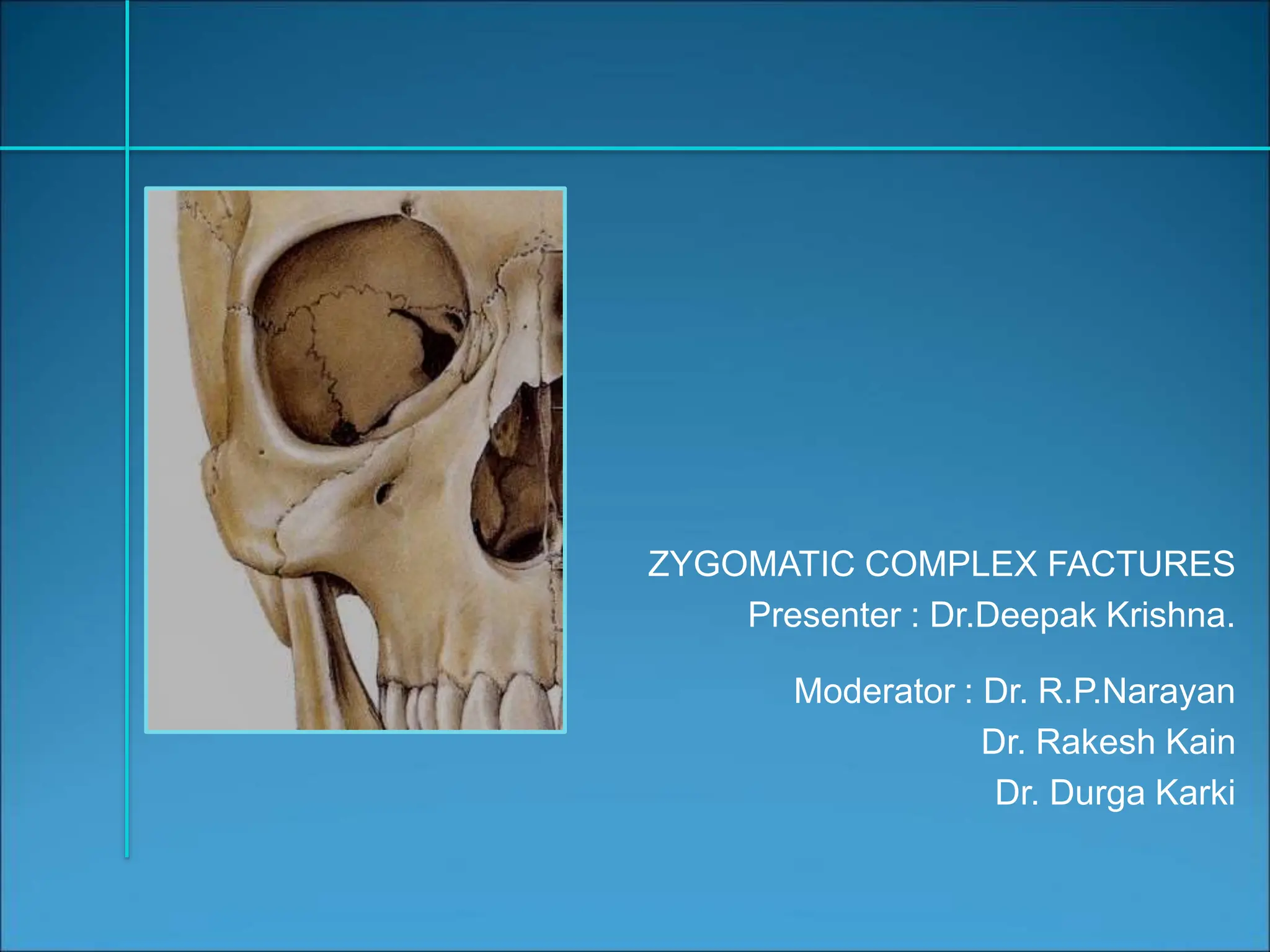 ZMC Fractures - Copy.ppt zygomatico maxillary fracture | PPT