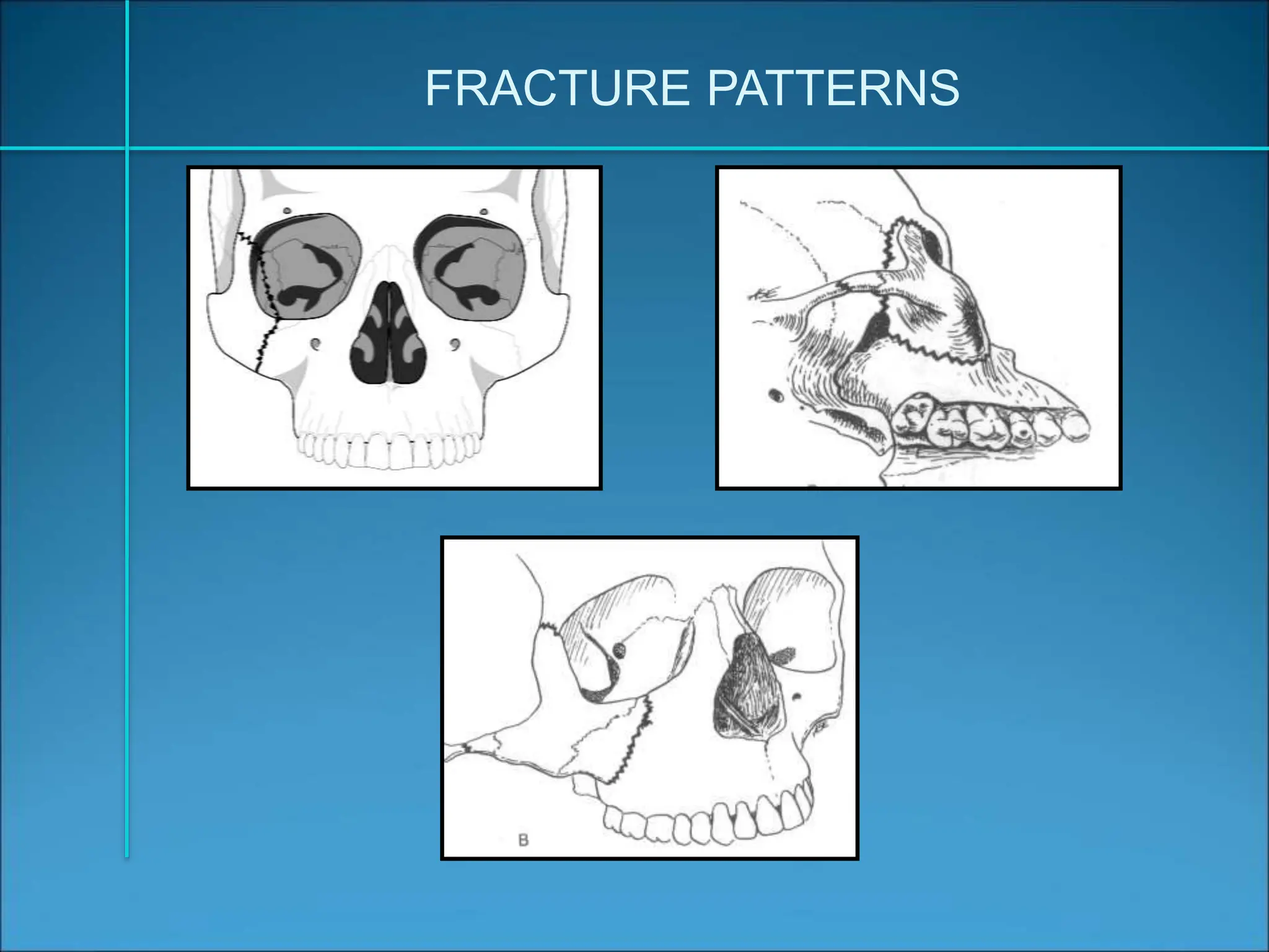 ZMC Fractures - Copy.ppt zygomatico maxillary fracture | PPT