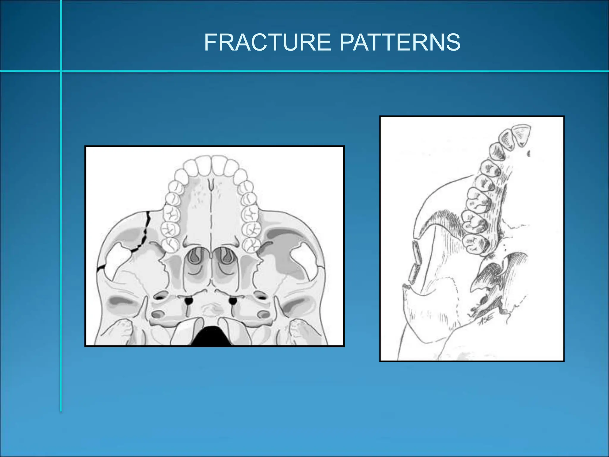 ZMC Fractures - Copy.ppt zygomatico maxillary fracture | PPT