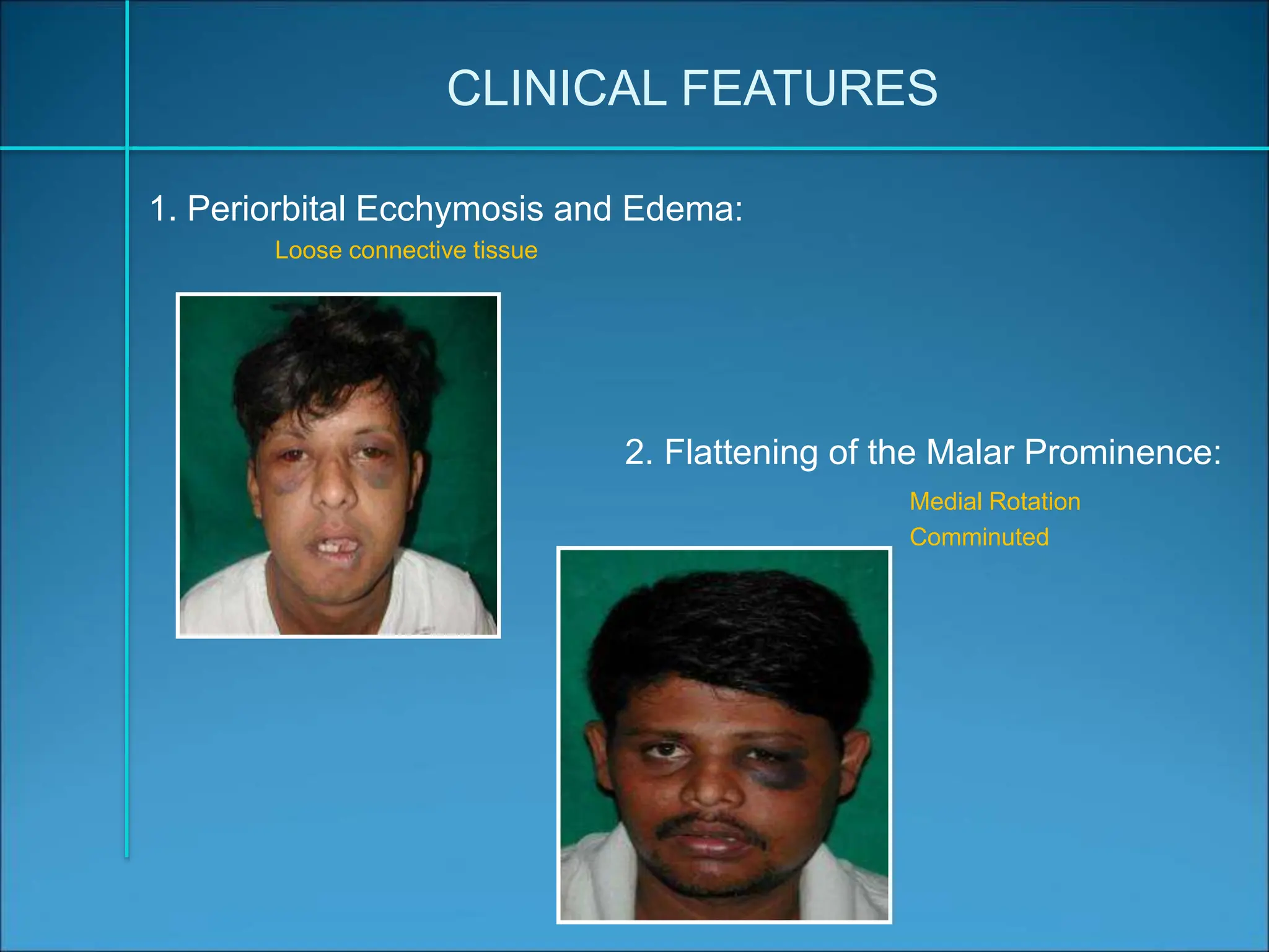 ZMC Fractures - Copy.ppt zygomatico maxillary fracture | PPT