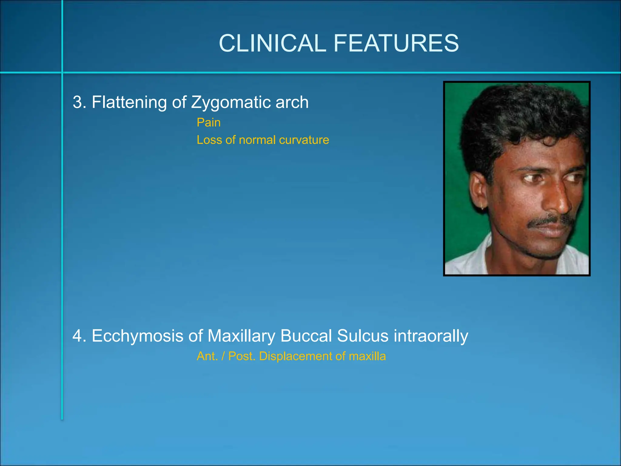 ZMC Fractures - Copy.ppt zygomatico maxillary fracture | PPT