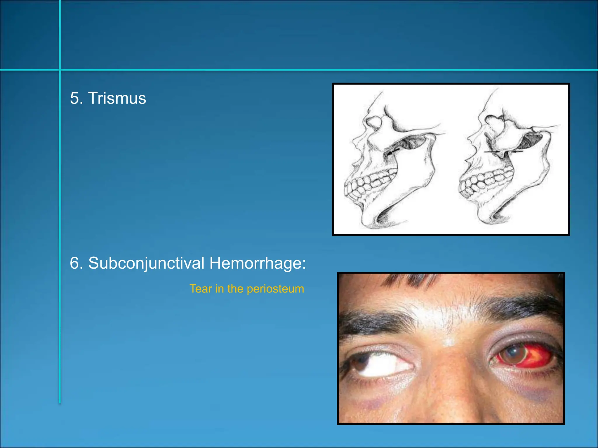 ZMC Fractures - Copy.ppt zygomatico maxillary fracture | PPT