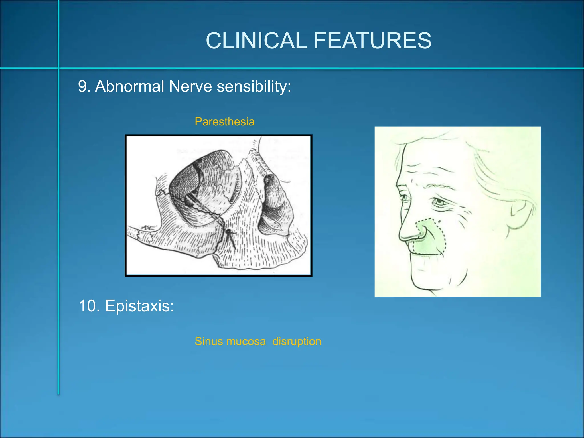 ZMC Fractures - Copy.ppt zygomatico maxillary fracture | PPT