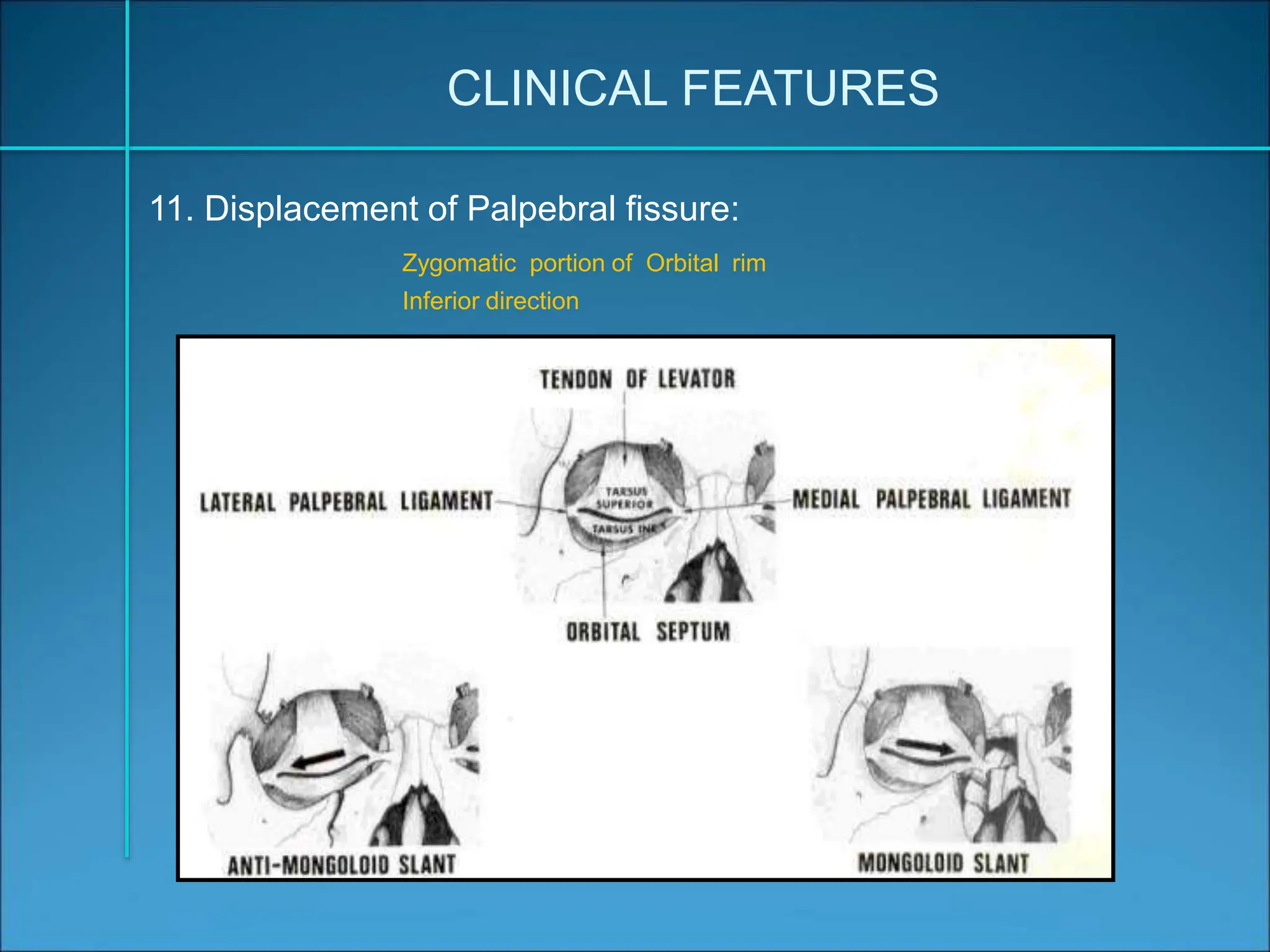 ZMC Fractures - Copy.ppt zygomatico maxillary fracture | PPT