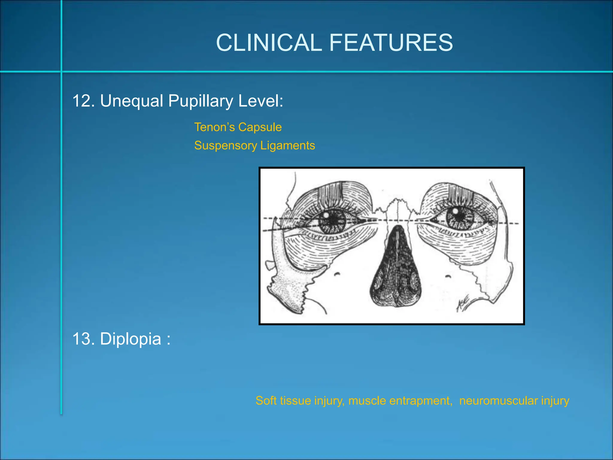 ZMC Fractures - Copy.ppt zygomatico maxillary fracture | PPT