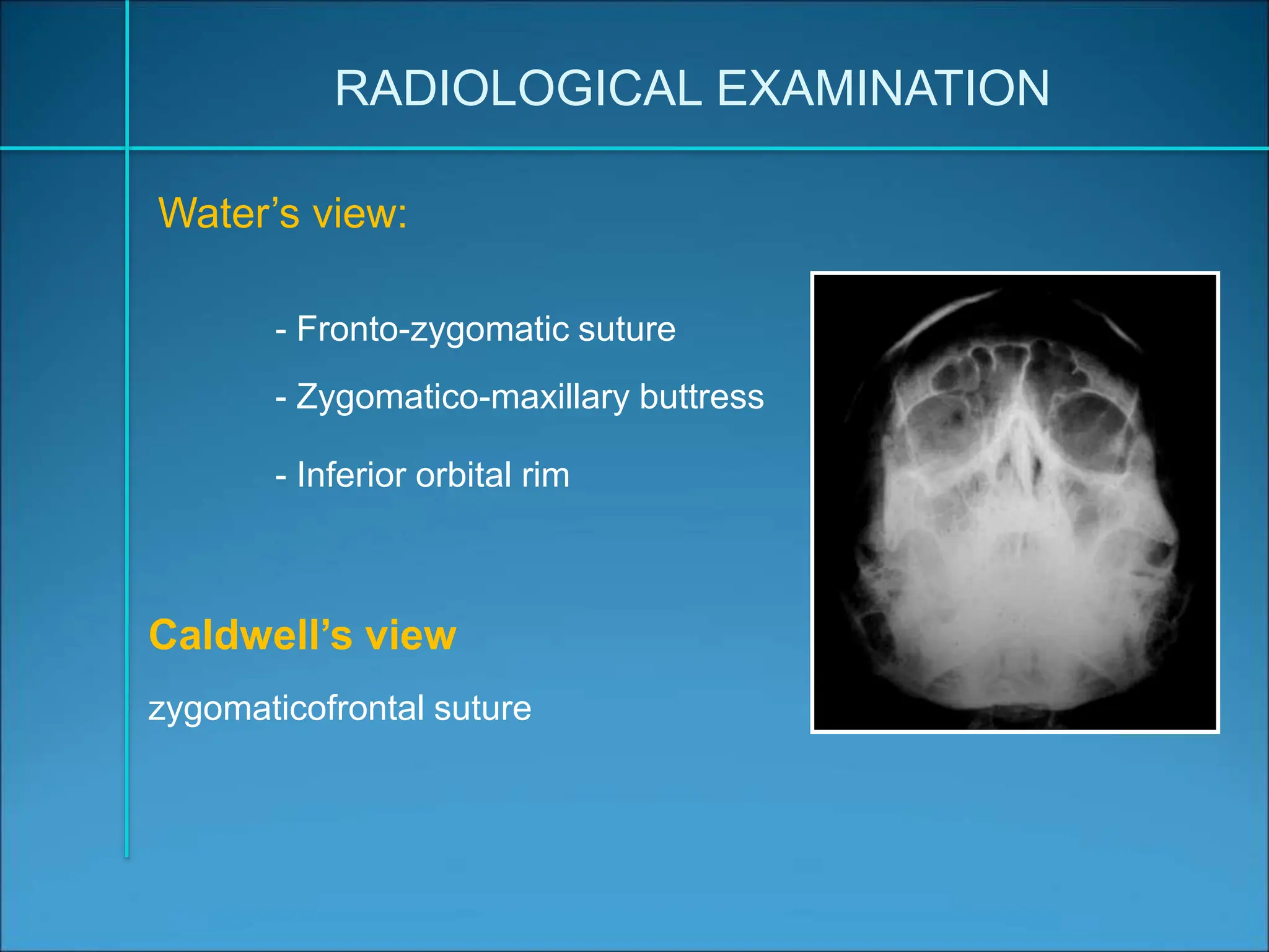 ZMC Fractures - Copy.ppt zygomatico maxillary fracture | PPT