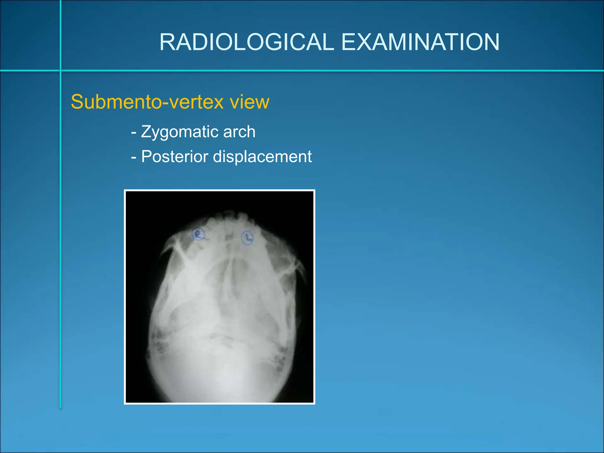 ZMC Fractures - Copy.ppt zygomatico maxillary fracture | PPT