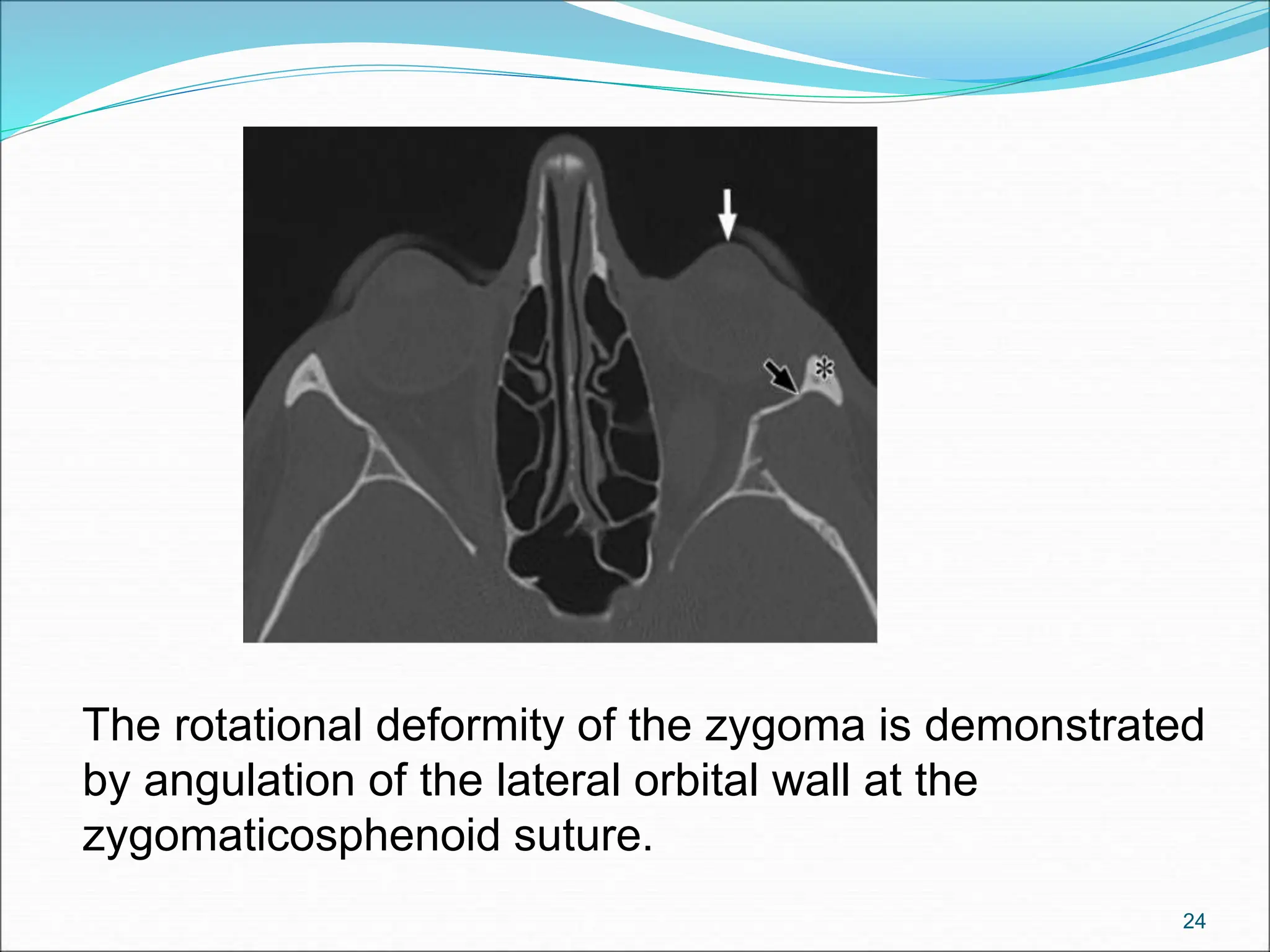 ZMC Fractures - Copy.ppt zygomatico maxillary fracture | PPT