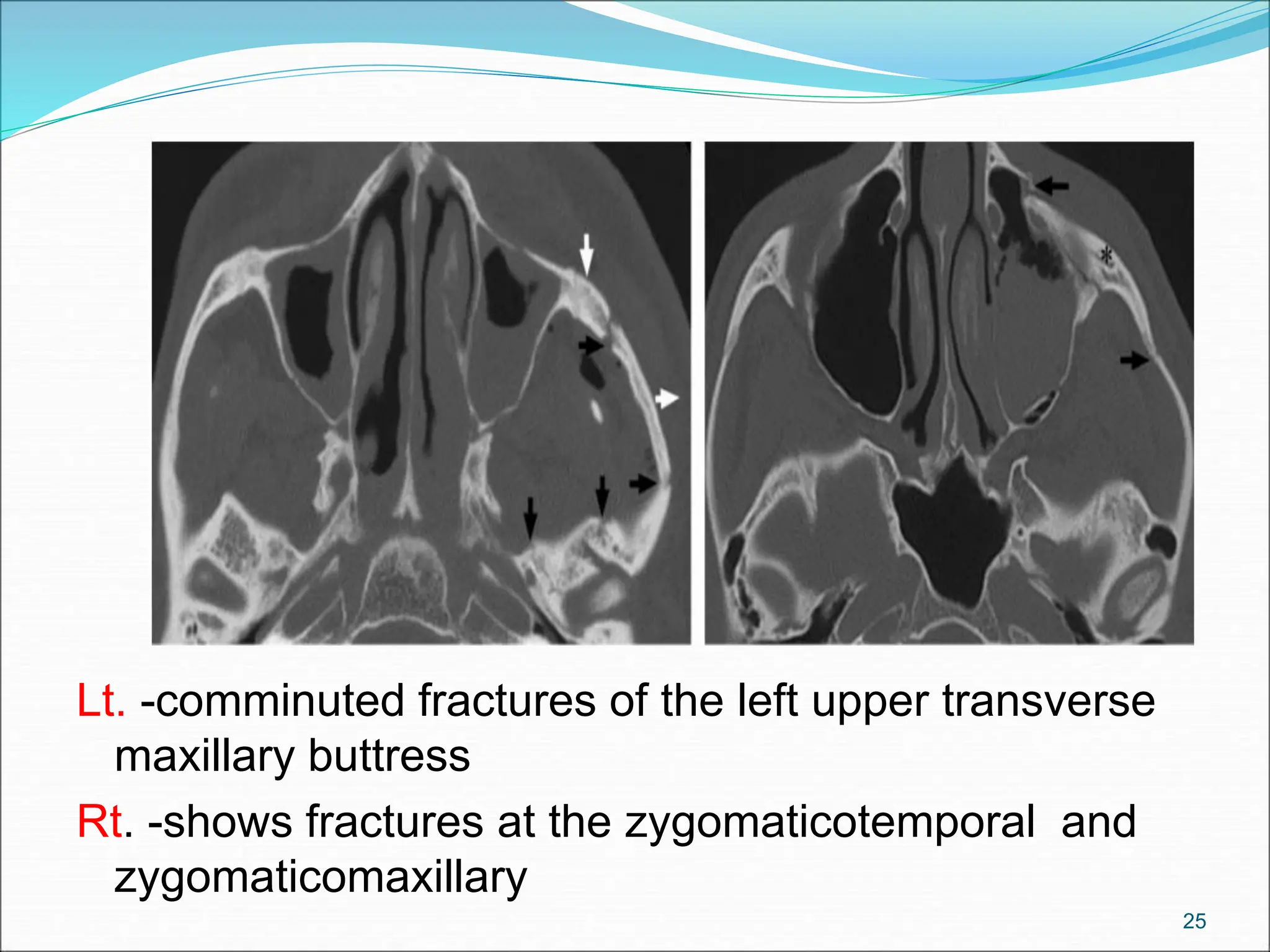 ZMC Fractures - Copy.ppt zygomatico maxillary fracture | PPT